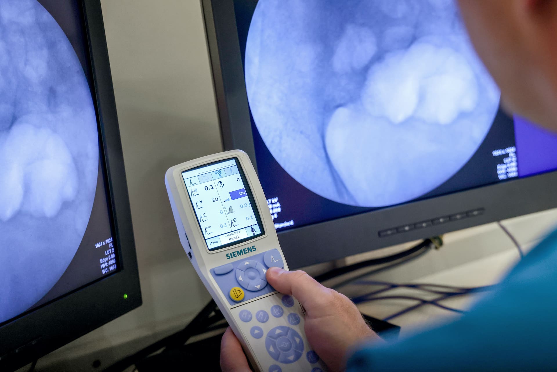 5 Key Reasons Lithotripsy is the Ideal Kidney Stone Treatment Option ...